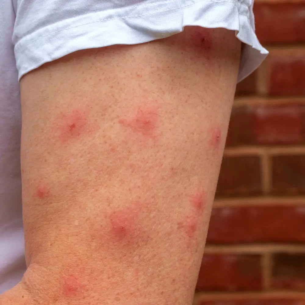 Skeeter Syndrome: Understanding Mosquito Bites and Their Serious ...